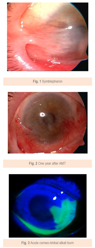 New clinical application of amniotic membrane transplant - Atlas Ocular