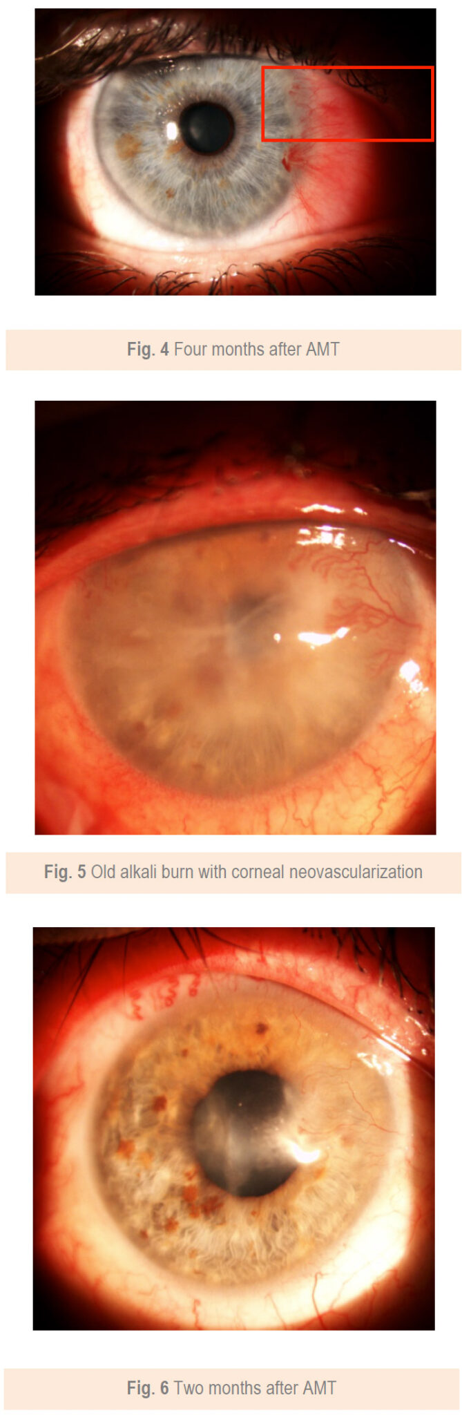 New clinical application of amniotic membrane transplant - Atlas Ocular